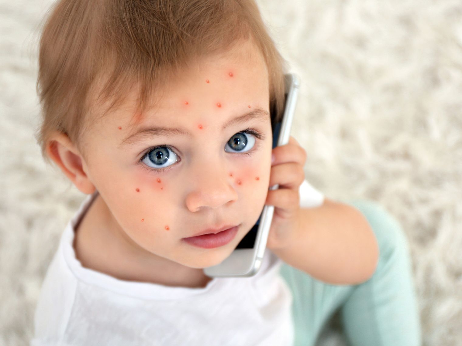 Windpocken – Verbreitete Kinderkrankheit auf dem Rückzug